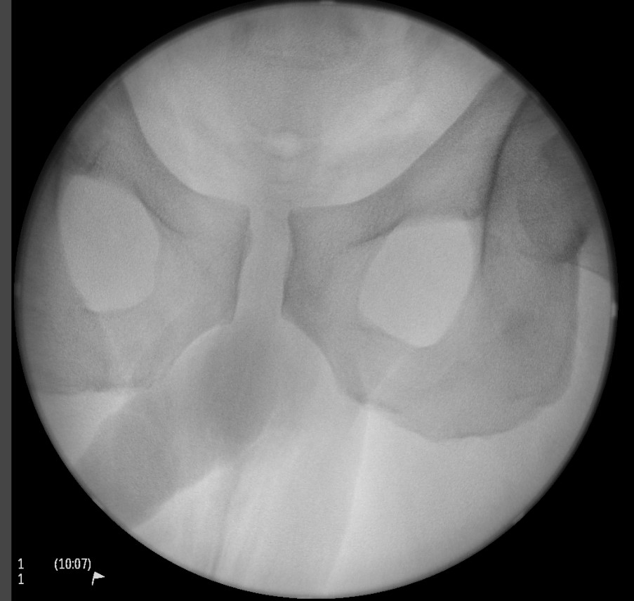 AP Compression | The Bone School